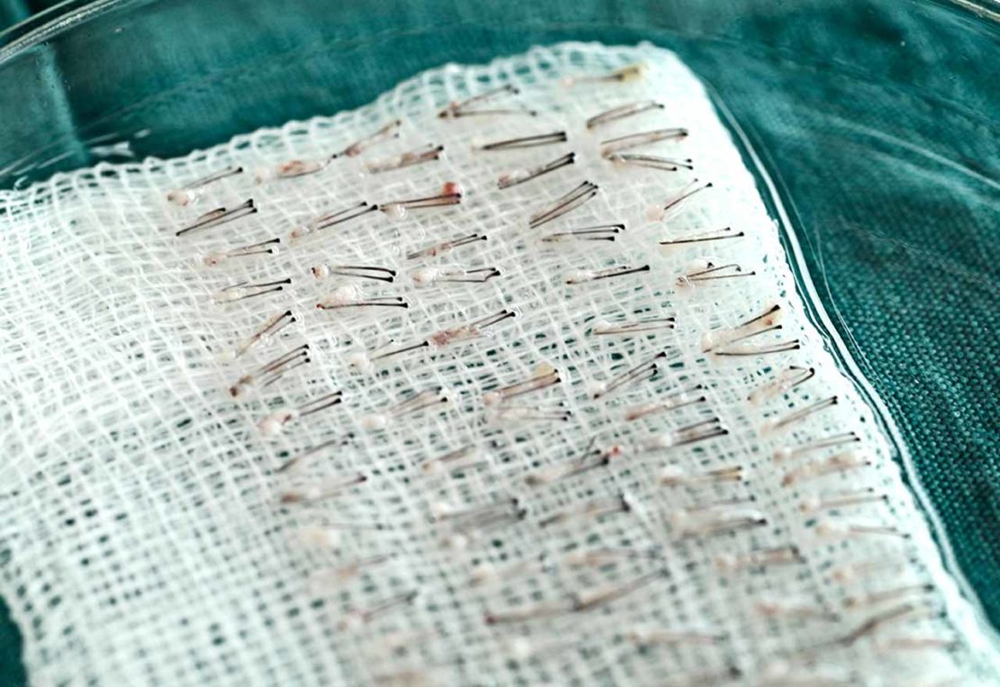 Les types des greffes - Calcul de greffe | Beauty Travels 24